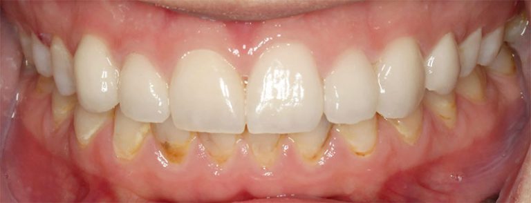 Smile Gallery - Sylacauga - Columbiana - Luma Dentistry